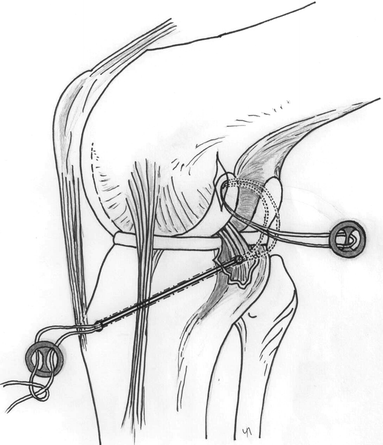 Arthroscopic fixation of posterior cruciate ligament avulsion fractures ...