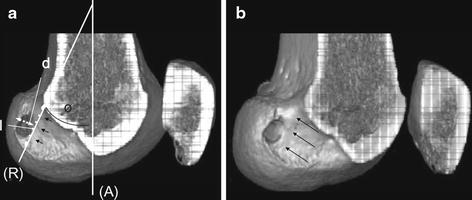 The resident’s ridge as an arthroscopic landmark for anatomical femoral ...