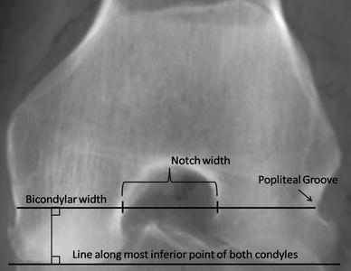 Assessment of correlation between knee notch width index and the three ...