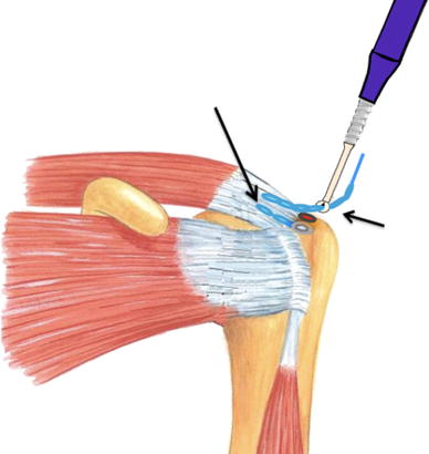 Clinical and structural evaluation of arthroscopic double-row suture ...
