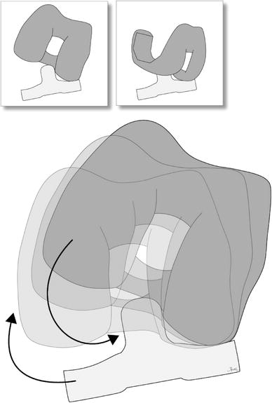 Posterior dislocation in total knee replacement: a price for deep ...