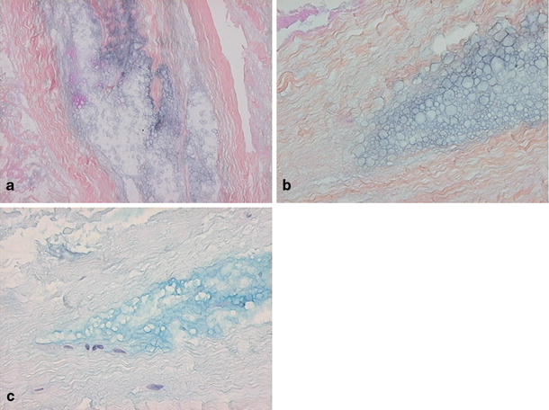 Anterior cruciate ligament mucoid degeneration: a review of the ...