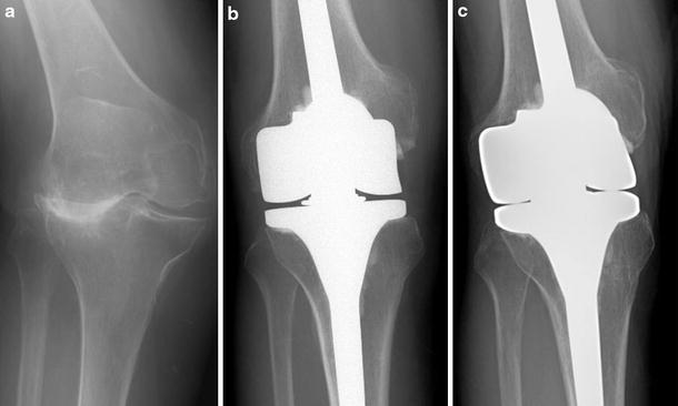 Primary total knee arthroplasty using rotating-hinge prosthesis in ...