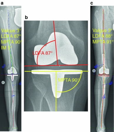 The painful knee after TKA: a diagnostic algorithm for failure analysis ...