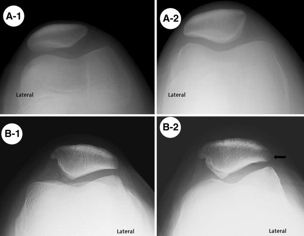 Lateral release and medial plication for recurrent patella dislocation ...