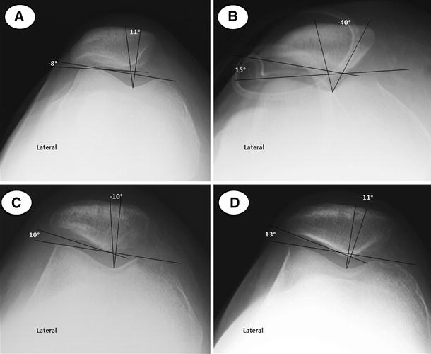 Lateral release and medial plication for recurrent patella dislocation ...