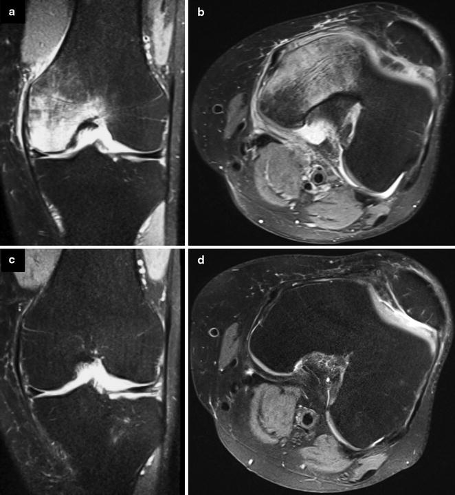 Spontaneous osteonecrosis of the knee (SONK) | SpringerLink