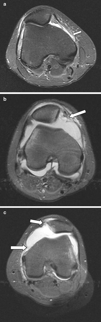 Non-surgical treatment for acute patellar dislocation with special ...