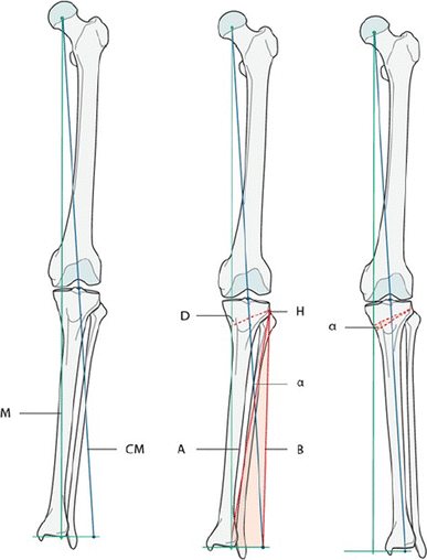 Biomechanics of high tibial osteotomy | SpringerLink