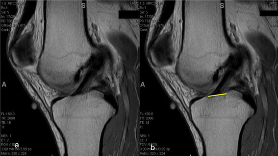 How to optimize the use of MRI in anatomic ACL reconstruction ...