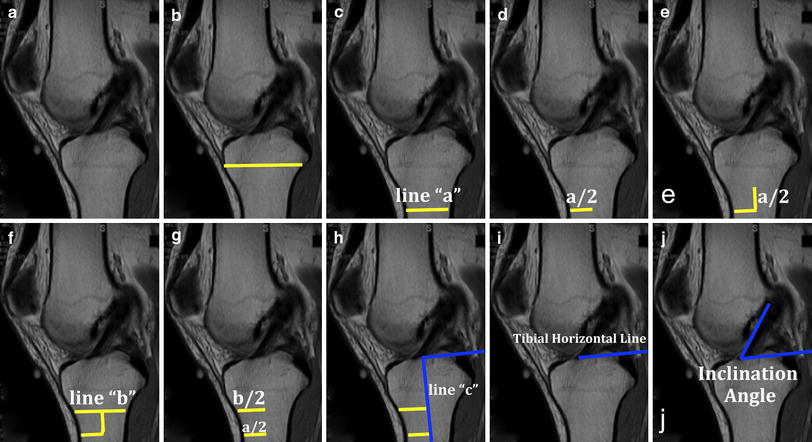 How to optimize the use of MRI in anatomic ACL reconstruction ...