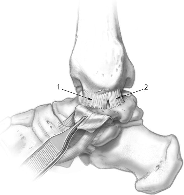 The deltoid ligament: an in-depth review of anatomy, function, and ...