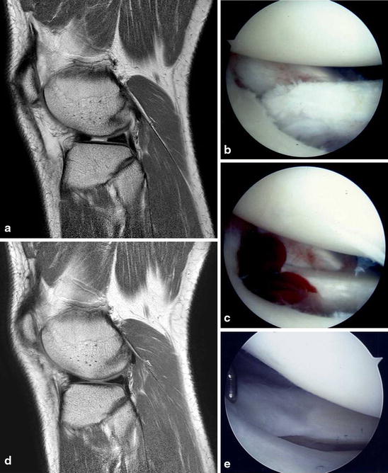 Arthroscopic inside-out repair of complete radial tears of the meniscus ...