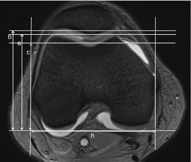 Evaluation of trochlear dysplasia using MRI: correlation between the ...