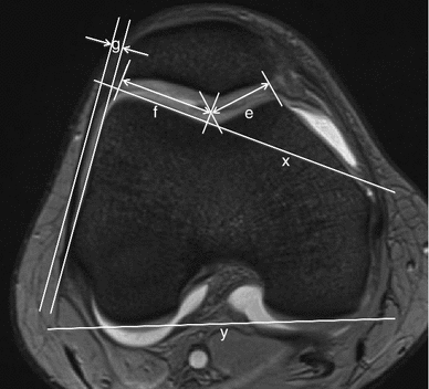 Evaluation of trochlear dysplasia using MRI: correlation between the ...