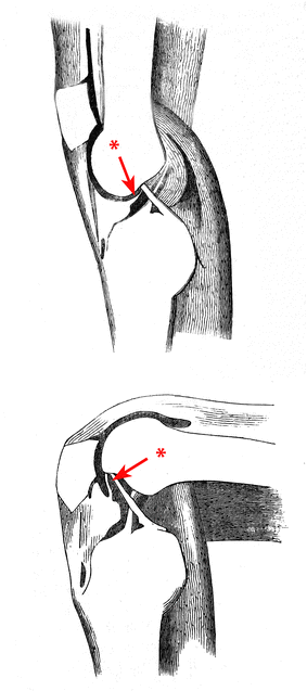 ‘The Sneaky Plica’ revisited: morphology, pathophysiology and treatment ...