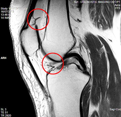‘The Sneaky Plica’ revisited: morphology, pathophysiology and treatment ...