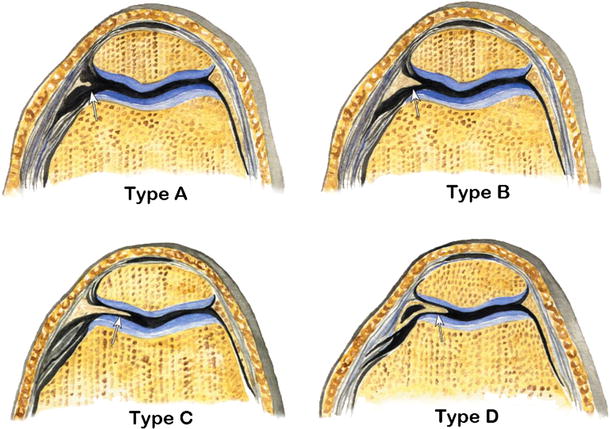 ‘The Sneaky Plica’ revisited: morphology, pathophysiology and treatment ...