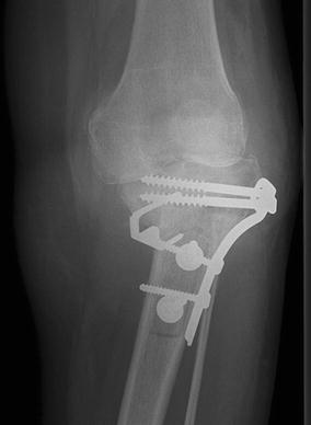 Tibial rotational osteotomy and distal tuberosity transfer for patella ...