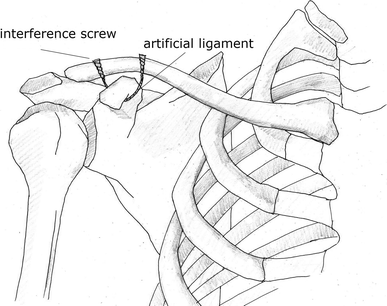Evaluation of the coracoclavicular reconstruction using LARS artificial ...