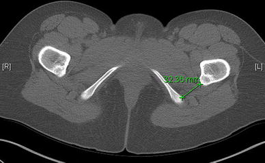 Ischiofemoral impingement of the hip: a novel approach to treatment ...