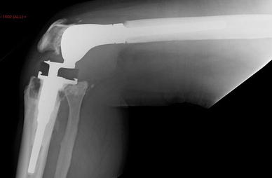 Mega prosthetic distal femoral arthroplasty for non-tumour indications ...