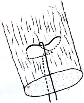 Novel single-loop and double-loop knot stitch in comparison with the ...