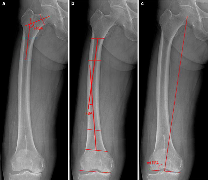 Femoral shaft bowing in the coronal plane has more significant effect ...
