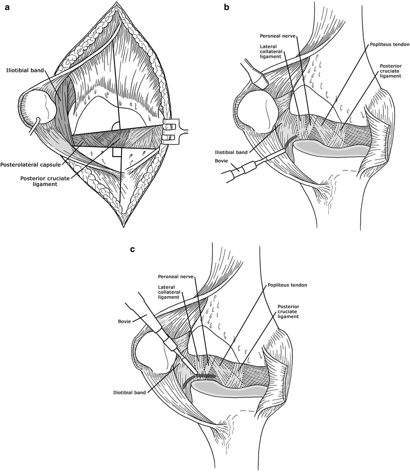 Total knee arthroplasty for valgus osteoarthritis: the results of a ...