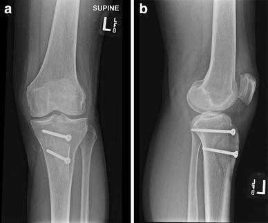 Early osteoarthritis of the patellofemoral joint | SpringerLink