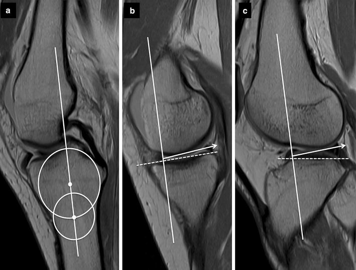 Increased lateral tibial slope predicts high-grade rotatory knee laxity ...