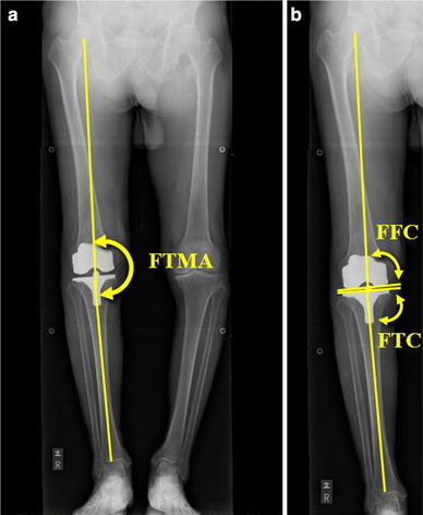 Remaining mild varus limb alignment leads to better clinical outcome in ...
