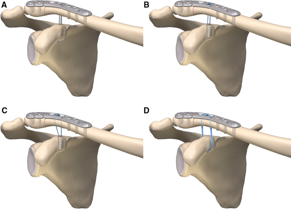 Lateral clavicle fracture with coracoclavicular ligament injury: a ...