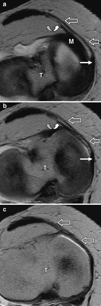 Medial patellotibial ligament and medial patellomeniscal ligament ...