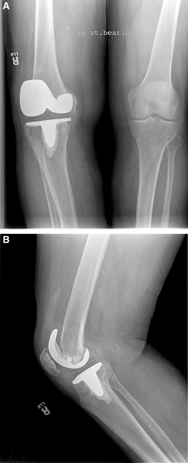 Revision total knee arthroplasty with porous-coated metaphyseal sleeves ...