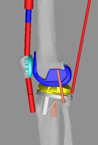 Bi-cruciate stabilized total knee arthroplasty can reduce the risk of ...