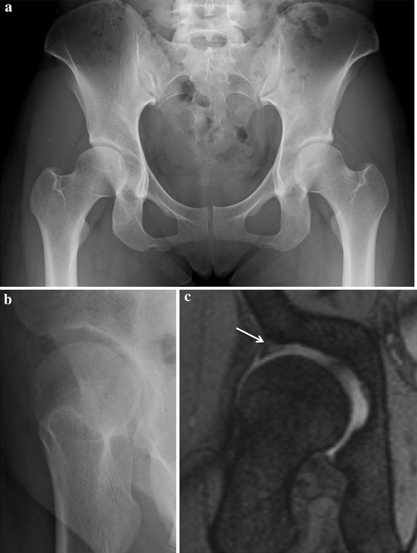 Endoscopic shelf acetabuloplasty can improve clinical outcomes and ...