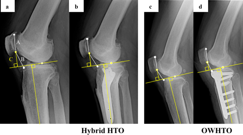 Hybrid high tibial osteotomy is superior to medial opening high tibial ...