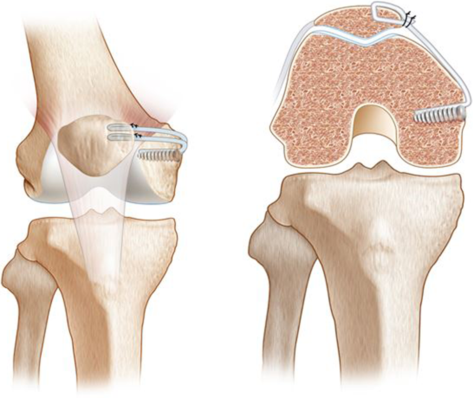 Lateral retinacular release is not recommended in association to MPFL ...