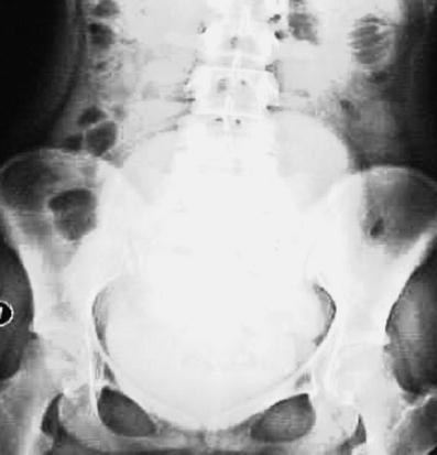 Management of an unusual case of atypical Mayer–Rokitansky–Kuster ...