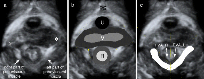 Pubococcygeus–puborectalis trauma after forceps delivery: evaluation of ...