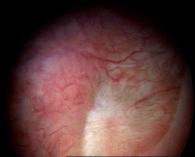 Transurethral and suprapubic mesh resection after Prolift® bladder ...