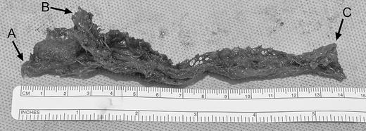 Lumbosacral osteomyelitis after robot-assisted total laparoscopic ...