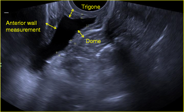 Bladder-wall-thickness ultrasound scan in the investigation of LUTS in ...