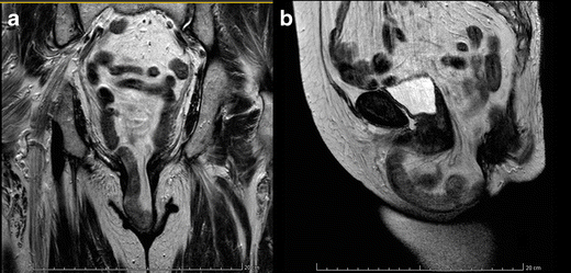 Perineal hernia extruding into the labium majus after multiple ...