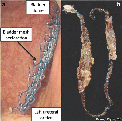 Surgical management of lower urinary mesh perforation after mid ...