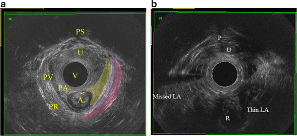How well can levator ani muscle morphology on 3D pelvic floor ...