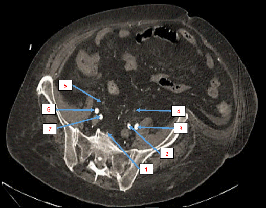 Characterization of the median sacral artery course at the sacral ...