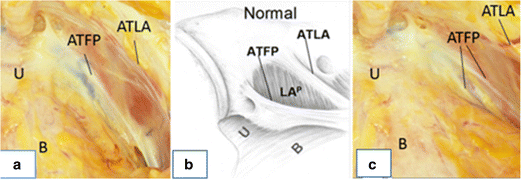 Paravaginal defect: anatomy, clinical findings, and imaging | SpringerLink