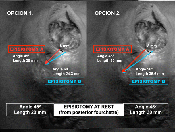 Behavior of perineum during delivery before fetal head expulsion ...
